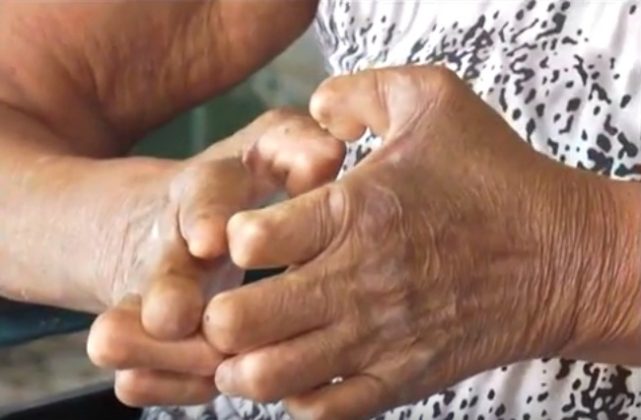 Número de casos de hanseníase preocupa autoridades da Serra